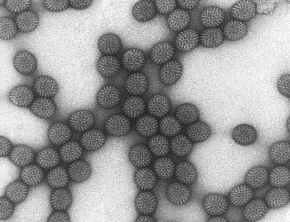 Bacolod City records rising rotavirus cases in kids under 5 years old ...